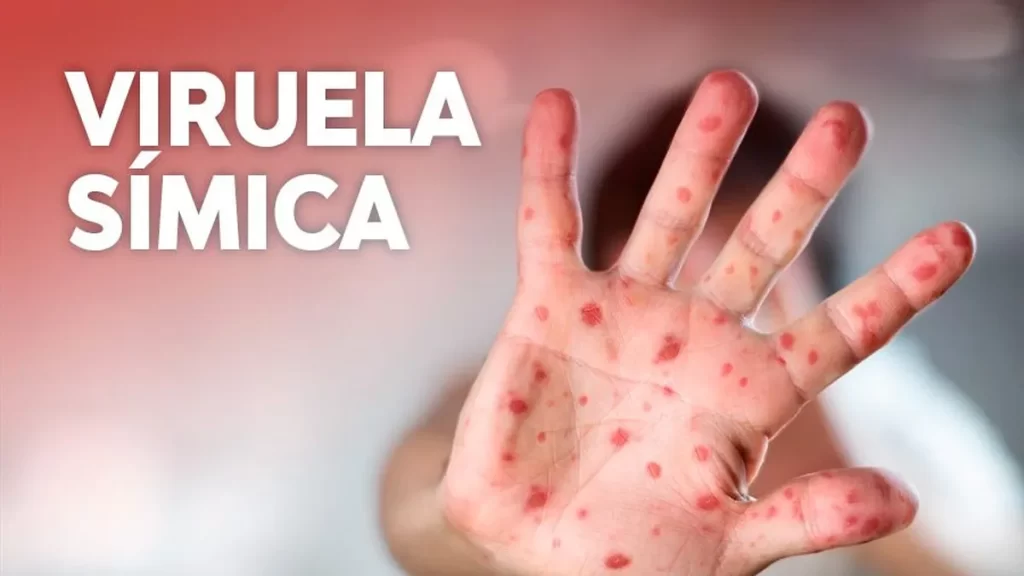 Situación epidemiológica ante el alerta por viruela símica